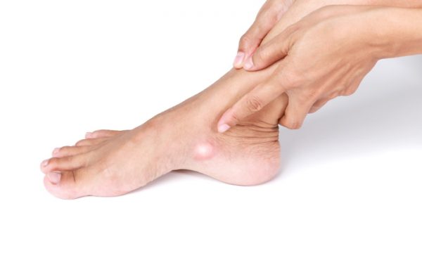 Accessory Navicular Bone Treatment Pune | Dr. Chetan Oswal