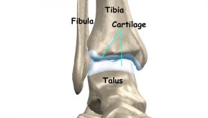 Cartilage Surgery of Talus - Pune Foot Ankle
