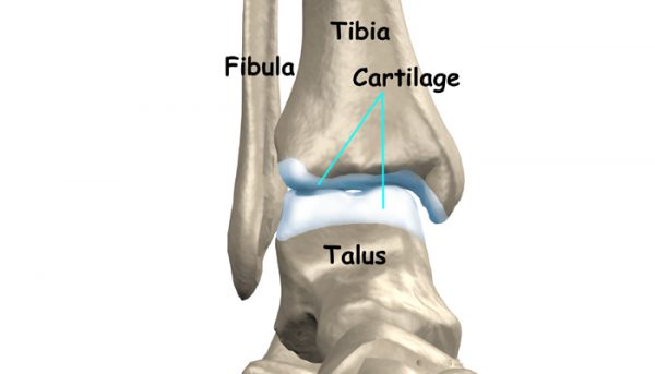 Cartilage Surgery of Talus - Pune Foot Ankle