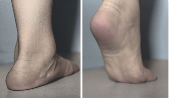 Flexible Flatfoot Treatment Pune | Dr. Chetan Oswal