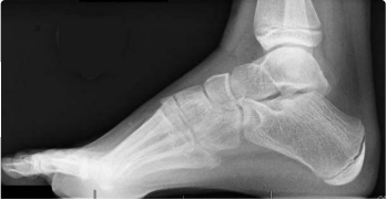 Charcot-Marie-Tooth Disease Treatment Pune | Dr. Chetan Oswal