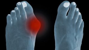 Big Toe Fusion Surgery & Treatment Pune, Pimpri Chinchwad PCMC ...
