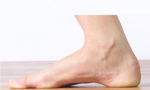 Cavus Foot Treatment in Pune | Orthowin Clinic | Dr. Chetan Oswal