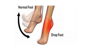 Foot & Ankle Treatments Pune, Pimpri Chinchwad PCMC | Orthowin Clinic ...