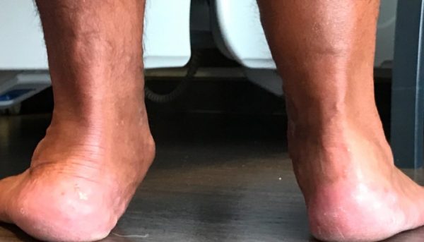Flat Foot Reconstruction Surgery Pune Dr Chetan Oswal