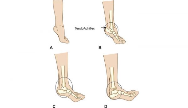 Deformity Correction of Ankle and Foot - Pune Foot Ankle