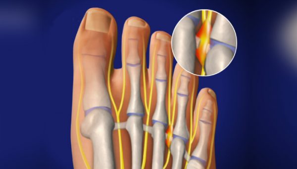 Foot & Ankle Treatments Pune, Pimpri Chinchwad PCMC | Orthowin Clinic ...