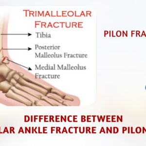 What is the Difference Between Trimalleolar Ankle Fracture And Pilon ...