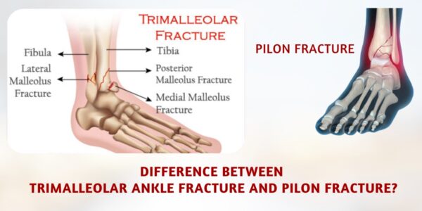What is the Difference Between Trimalleolar Ankle Fracture And Pilon ...
